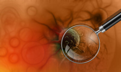 Pilonidal Cyst Surgery Video - Pilonidal Expert
